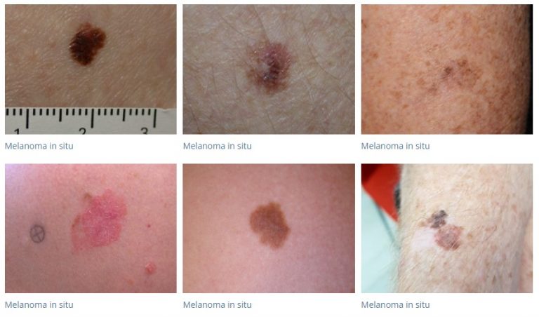Melanoma-in-situ-9 | TeachingBrave